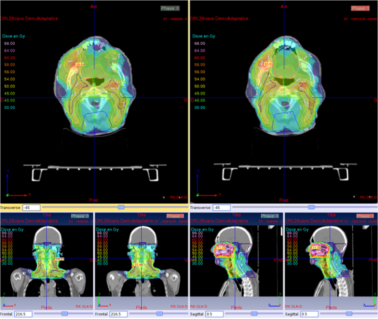 Treatment of cancer through radiation oncology - DOSIsoft